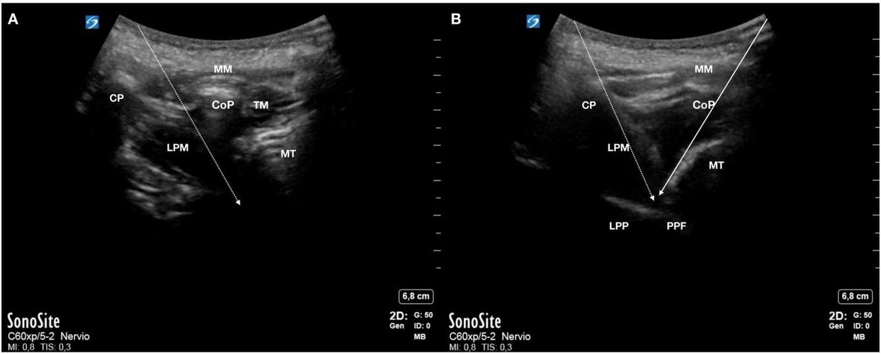 Ultrasound-guided maxillary nerve block via the pterygopalatine fossa ...