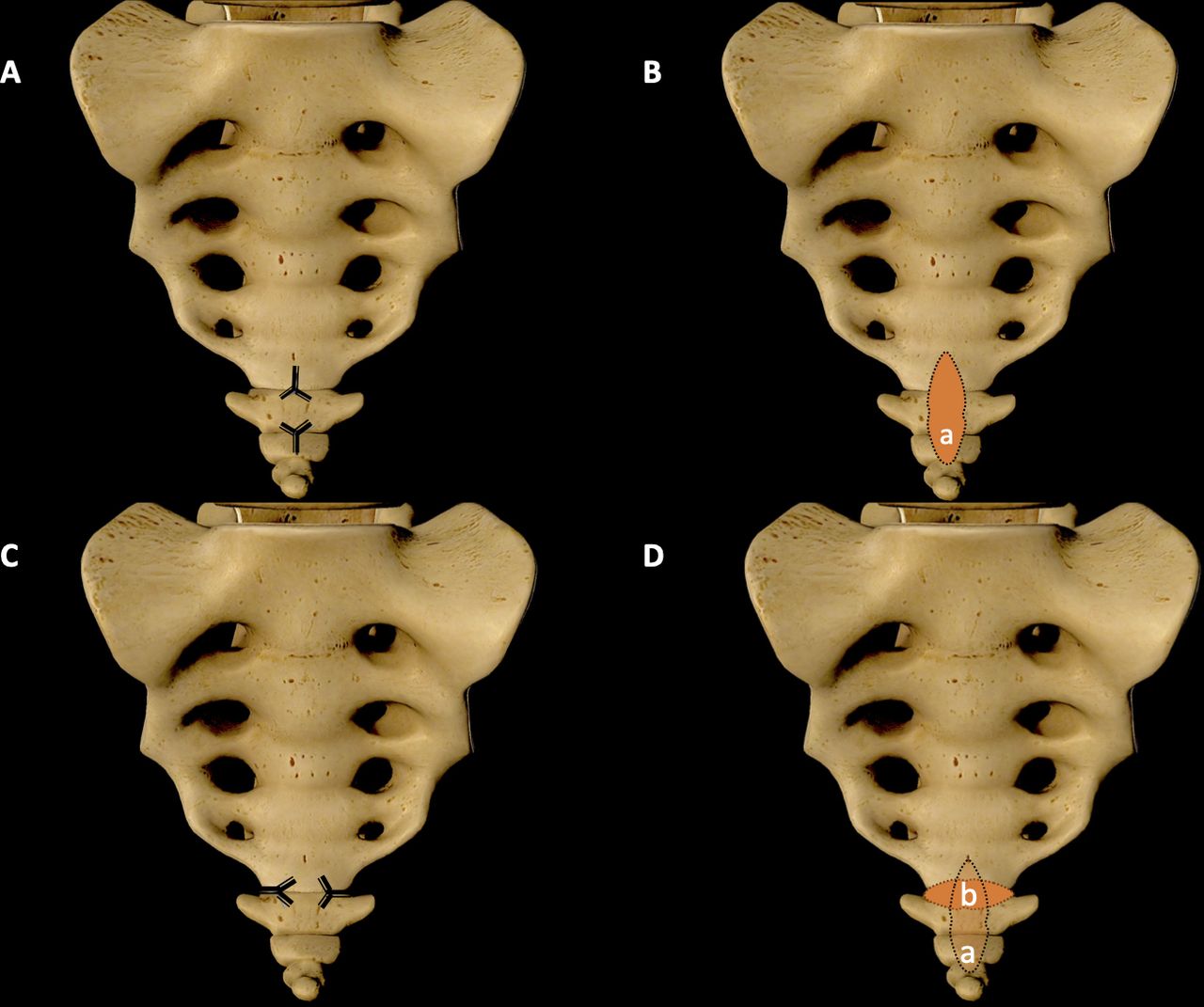 Novel approach for pericapsular radiofrequency ablation of ...