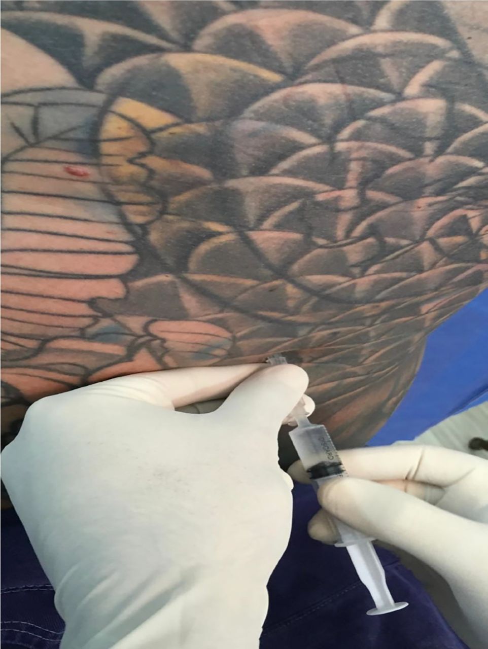OP21 Spinal anesthesia in patients with lumbar tattoos: case report and ...