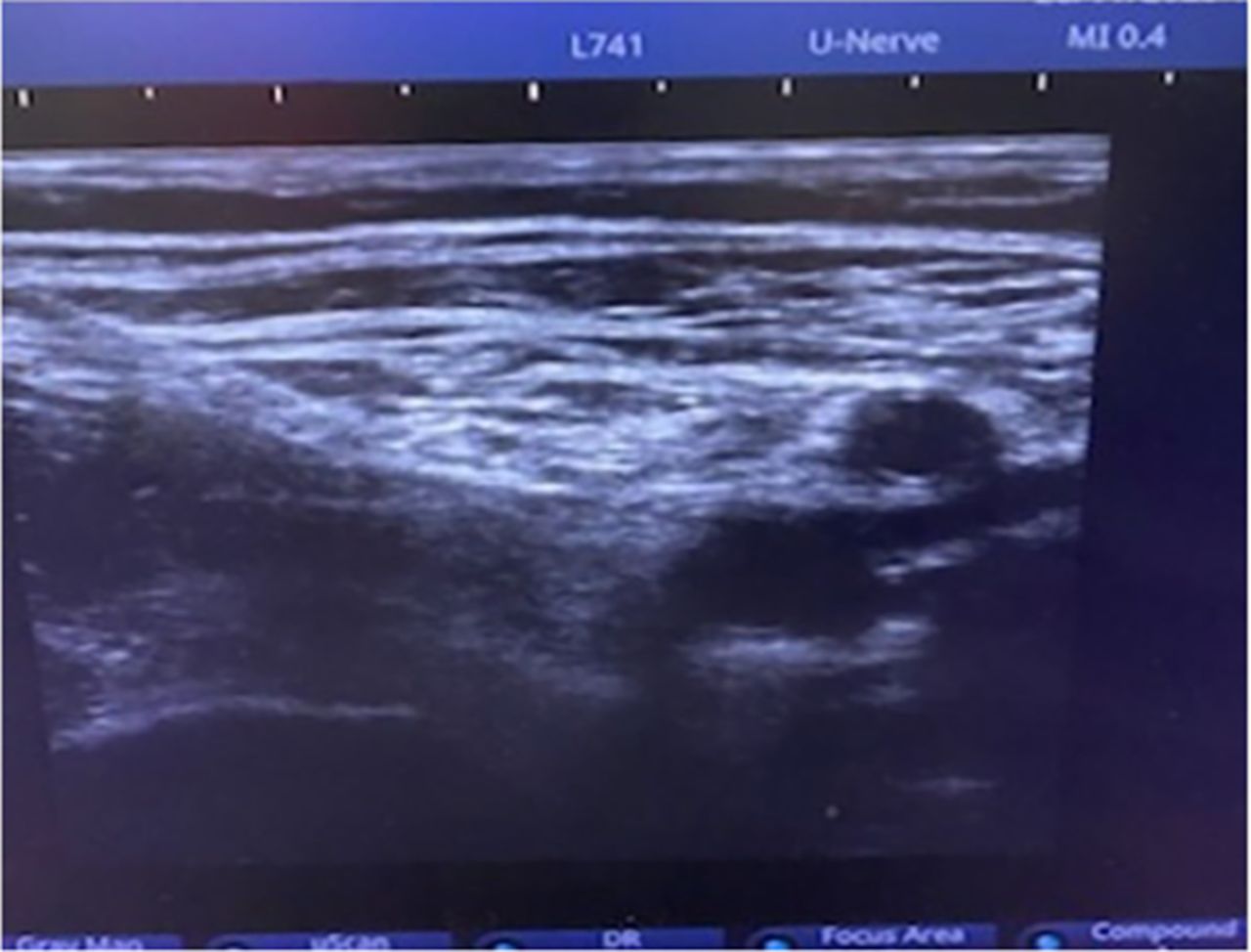 P120 Combination of ultrasound-guided femoral and popliteal nerve ...