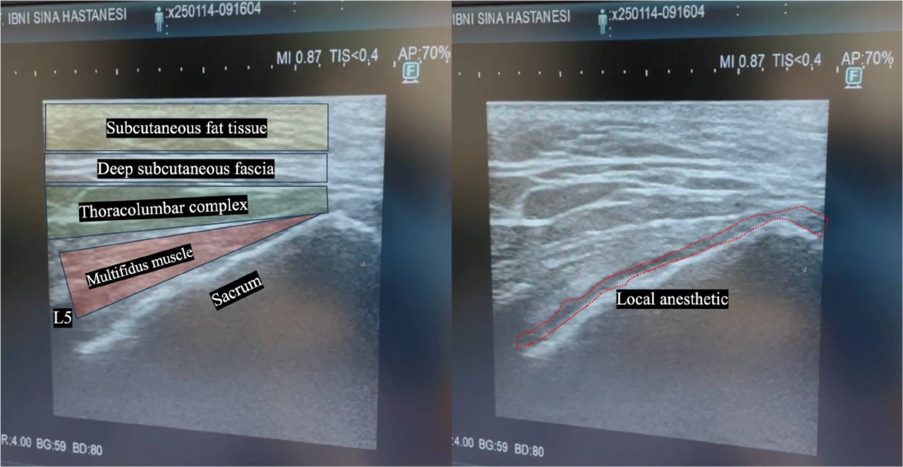 P136 Sacral multifidus plane block in surgical anesthesia for ...