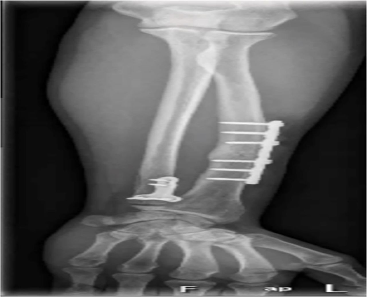 P147 Bilateral infraclavicular block for forearm surgery in a ...