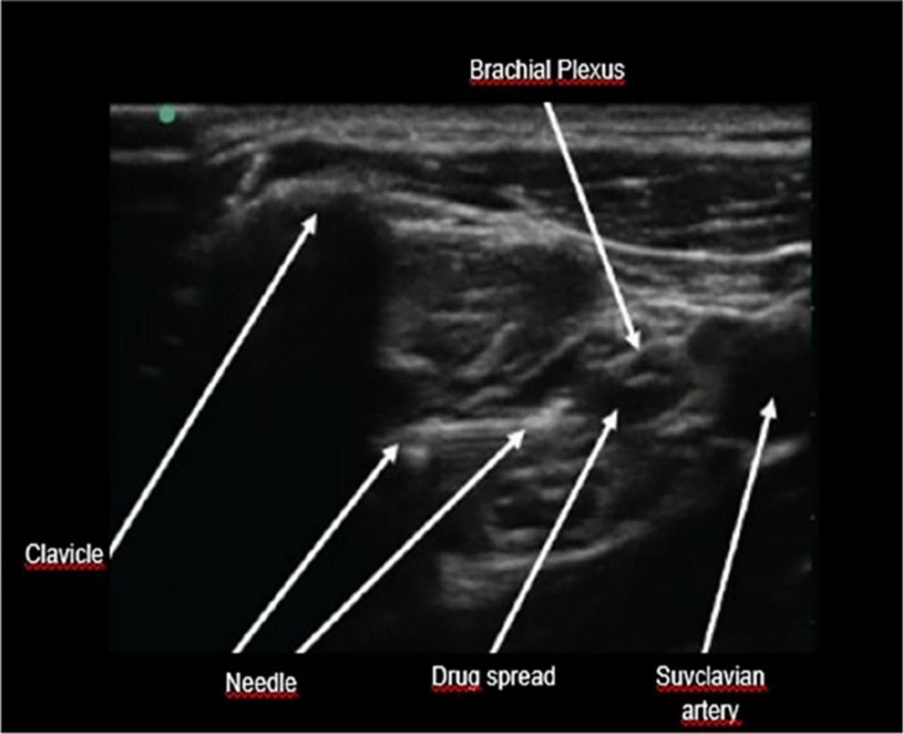 P171 Retroclavicular approach of brachial plexus block: an unusual ...