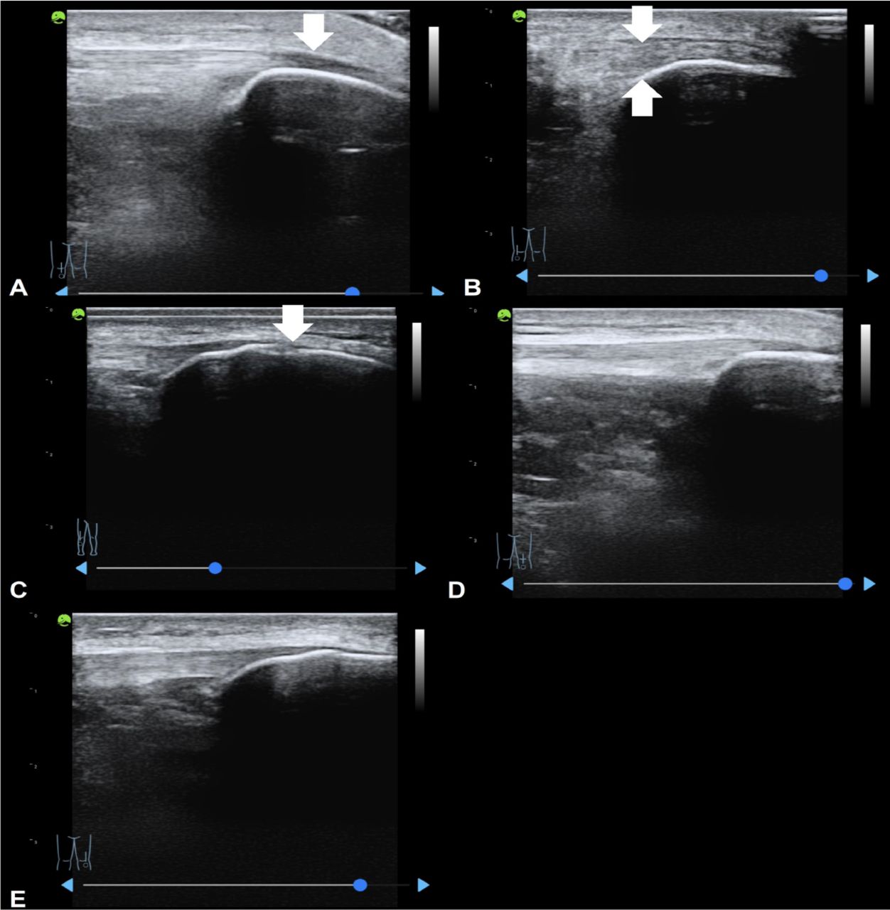 EP005 Focused shockwave therapy on patellar enthesopathy in ...