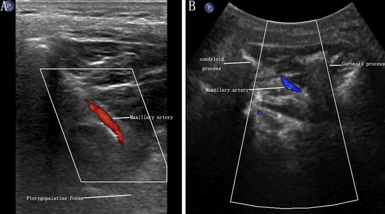 Ultrasound-guided maxillary nerve block via the pterygopalatine fossa ...