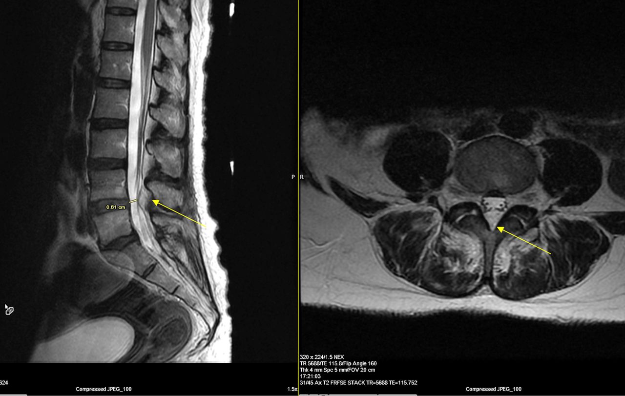 Epidural abscess after lumbar medial branch blocks in a patient on ...