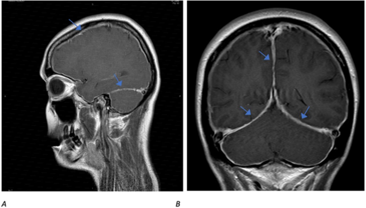 Brain MRI features of postdural puncture headache | Regional Anesthesia ...